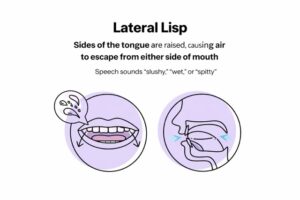 Lisps in Speech Therapy: Types & Proven Treatment